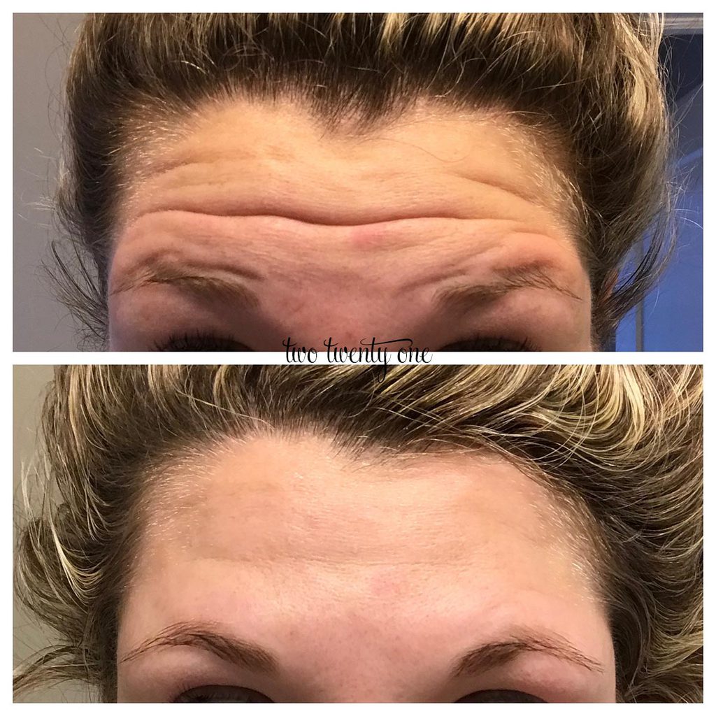 Botox Frown Lines Before And After