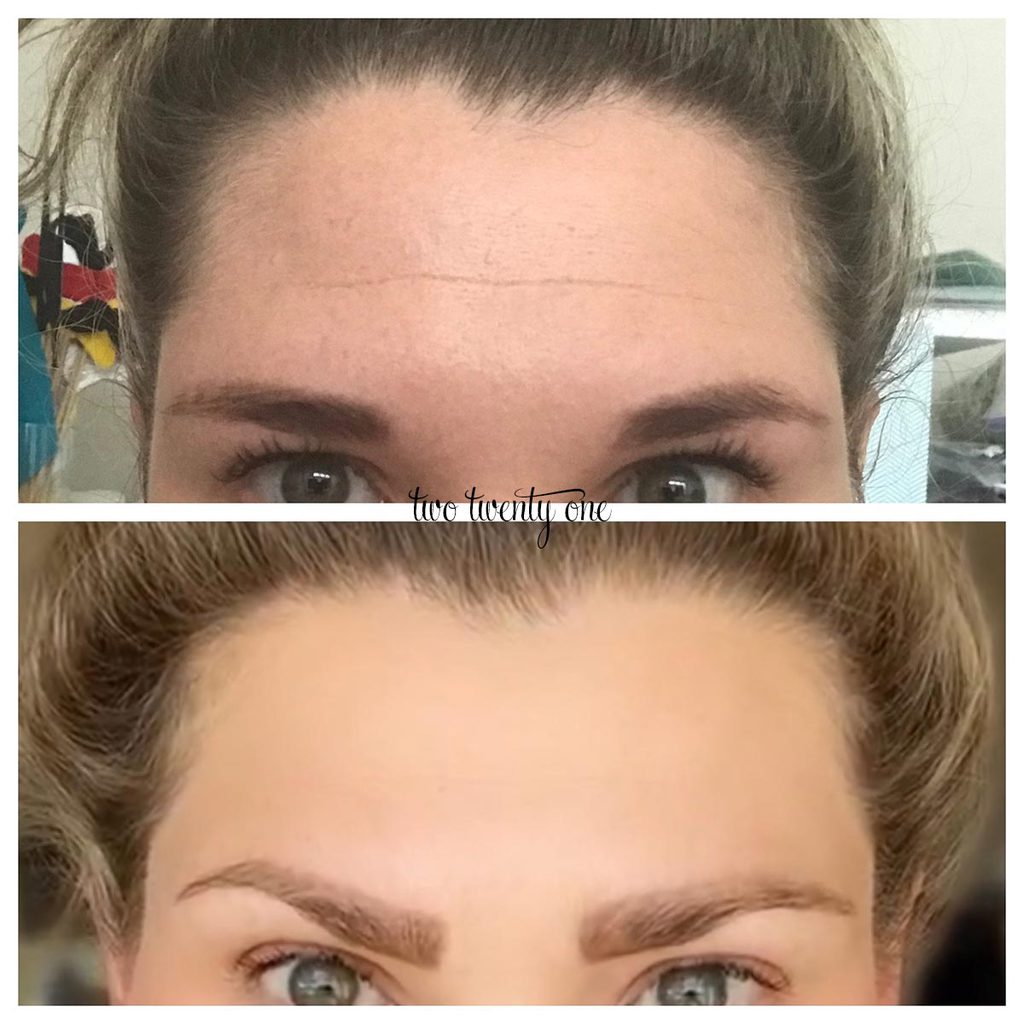 Botox Before And After Forehead Botox Before And After Forehead